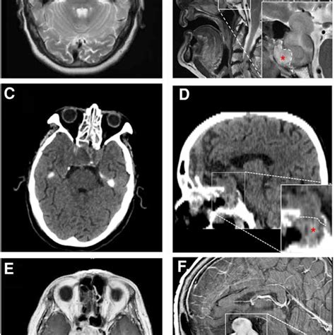 Mri Abef And Ct Cd Findings In A Patient With Pituitary Adenoma