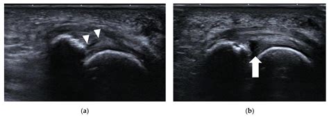 High Resolution Ultrasound Of The Forefoot And Common Pathologies