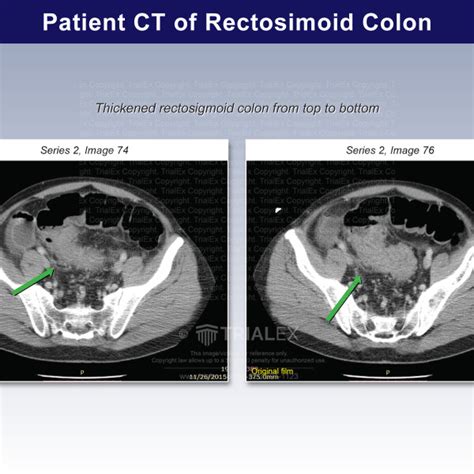 Medical Legal Exhibits Legal Animations And Trial Graphics