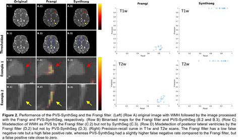 Contrast‐agnostic Deep‐learning‐based Detection Of Perivascular Spaces