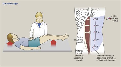 Centrally Mediated Abdominal Pain Syndromes Medicine