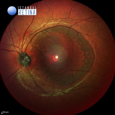 72 Optic Disc Pit Maculopathy Oct Club
