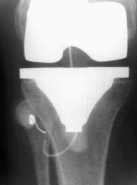 Angiogram Showing The Coil In Situ Before Embolisation Download
