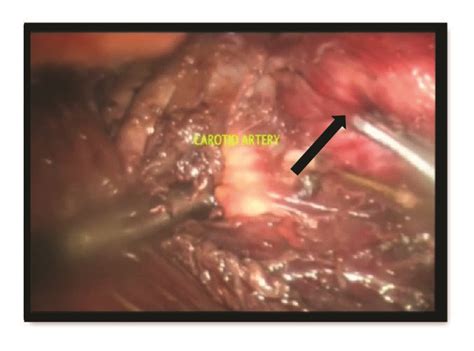 A H Intraoperative View Of Key Steps During Endoscopic Thyroidectomy