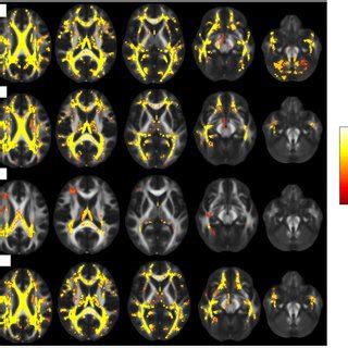 Differences In DTI Measures Between Patients And Controls Statistical Download Scientific