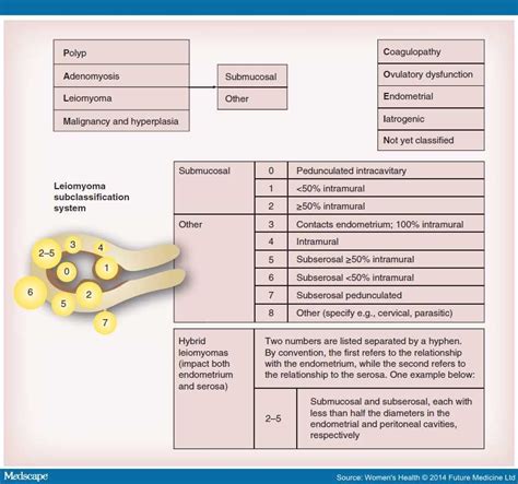 Uterine Fibroids Associated With Infertility