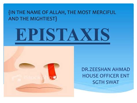 Epistaxis Ppt