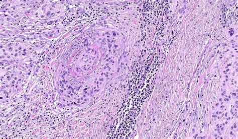 Presence De Microscopic Metastasis Microsatelitosis Deep To A Primary Download Scientific
