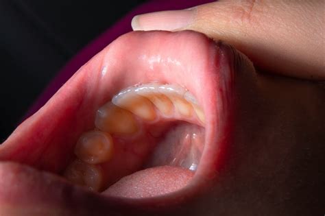 How To Spot The Warning Signs Of A Throat Infection Before Its Too La