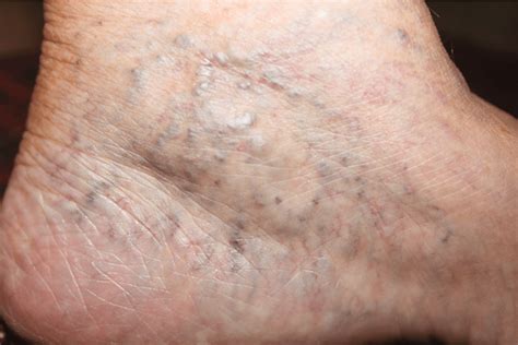 Spider Veins Causes And Treatment Veinsolutions Flint Mi