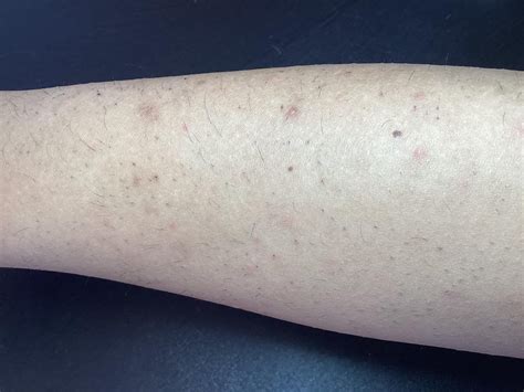 Ingrown Hairs After Waxing Hands [hair Removal] R Skincareaddiction