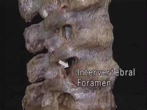 Intervertibral Disc Prolapse Pptx