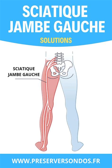 Sciatique Jambe Gauche Causes Solutions Exercices Sciatique