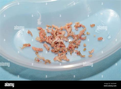 Prostate Diagnostic Surgery Image 8 Of 8 Prostate Tissue Extracted