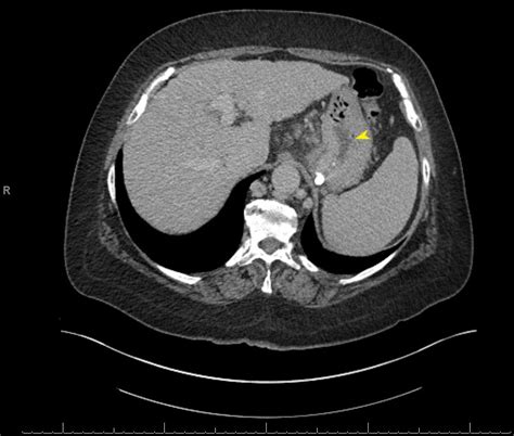 Gastric Varices Ct