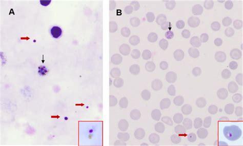 Diagnosis Of Plasmodium Malariae Infection And Presence Of Howell Jolly Download Scientific