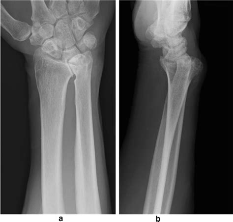 A 77 Year Old Male With Edc Tendons Of The Ring And Little Finger