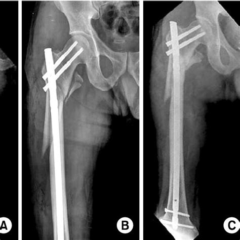 A A 49 Year Old Male Sustained Winquist Hansen Type Iv Otaao Type Download Scientific