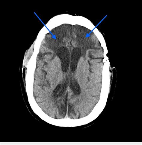 Ct Of The Head Horizontal Cut Showing Frontal Lobe Atrophy Blue