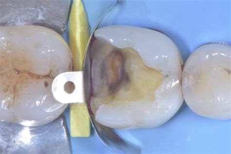 One Stage Direct Surgical Restorative Approach In Extensive Class Ii