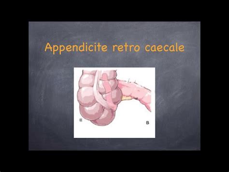 Emplacement De Lappendice Appendicite Reconnaître Les Symptômes