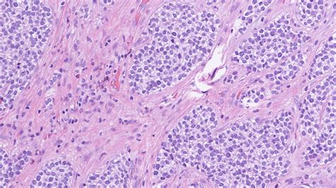 Round Cell Sarcoma With Ewsr1 Fusion Atlas Of Pathology