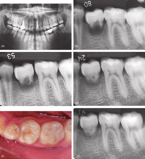 Arrest Of Root Development A A Third Molar In This 16 Year Old Boy