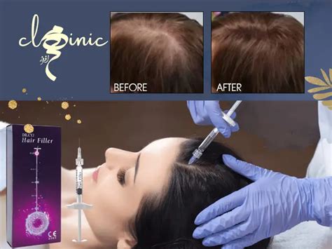 فیلر مو هیر فیلر کلینیک مهر افروز