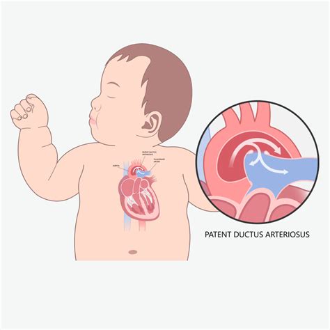 Patent Ductus Arterious Causes Symptoms And Treatment Option