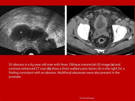 Imaging Vastitis Differentitis Funiculitis Seminal Vesiculitis Dr Ahmed