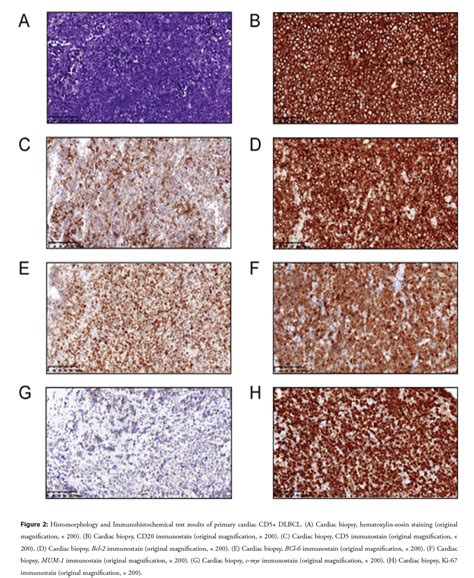 Primary Cardiac Cd5 Positive Diffuse Large B Cell Lymphoma With B