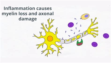 The Nervous Case Of Multiple Sclerosis Demystifying Medicine