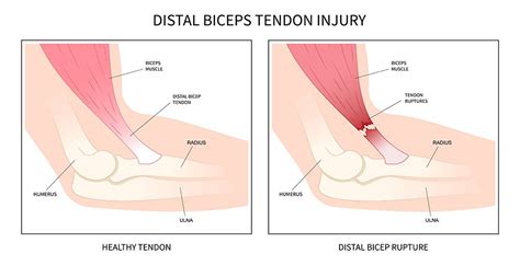 Distal Biceps Rupture Orthopedic Institute