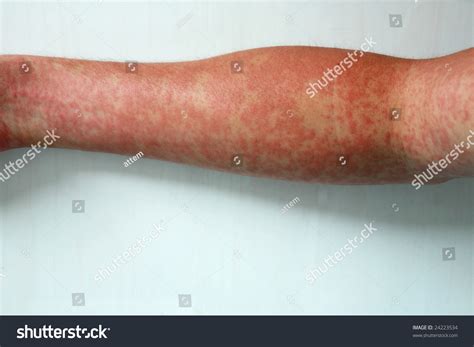 Typical Macular Rash Forearm This Could Foto De Stock Editar Ahora