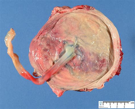 Acute Chorioamnionitis Human Pathology Photos Pictures Videos