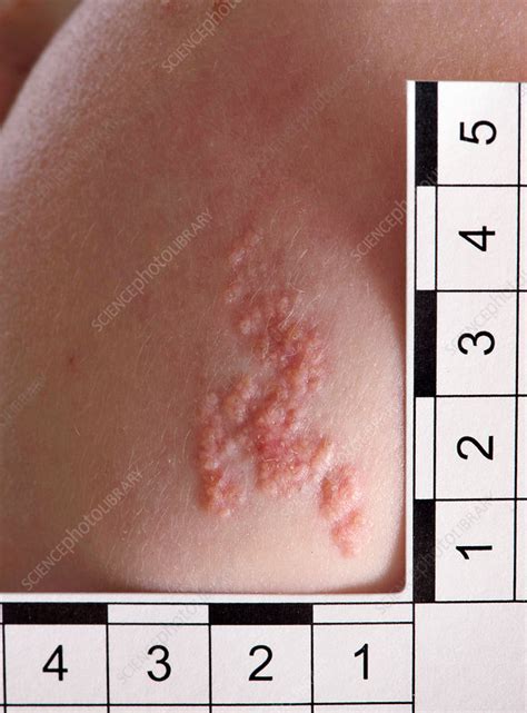 Linear Epidermal Naevus Stock Image C0382315 Science Photo Library