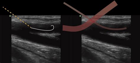 Distal Perfusion Cannula Alfred Ecmo Guideline