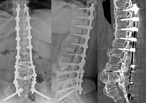 Images After Surgery A Two Stage 360° Fusion Surgery Was Carried Out