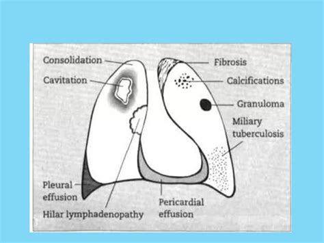 Pulmonary Tuberculoma Ppt Free Download