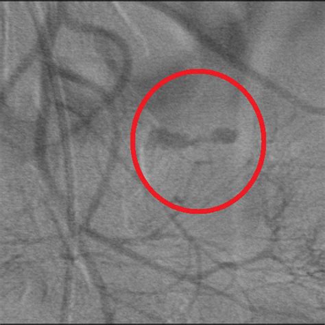 Mesenteric Angiography Bleeding In The Third Part Of The Superior Download Scientific Diagram