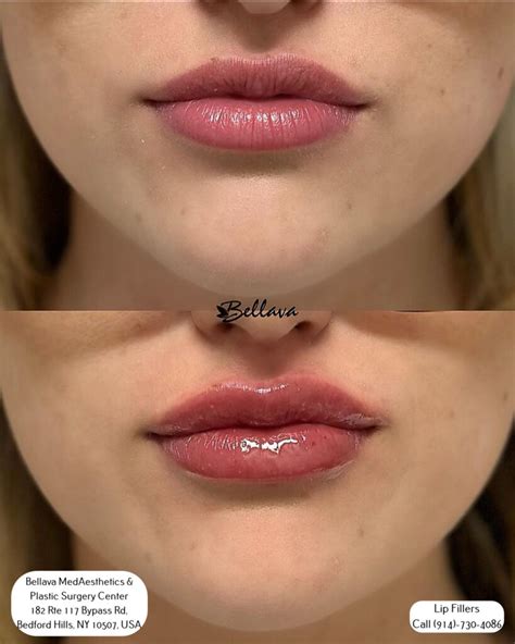 Achieving Natural Looking Lip Fillers A Guide To Fuller Lips Without Losing Authenticity