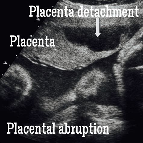 10 Causes Of Placental Abruption Everything You Need To Know