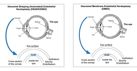 Endothelial Corneal Graft Surgery University Hospitals Sussex Nhs