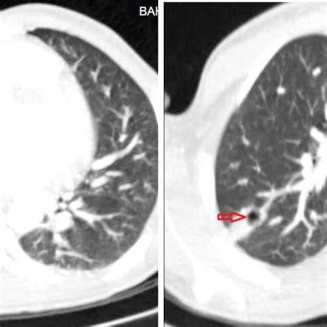 Pdf Infective Endocarditis Uncovered A Very Rare Congenital Heart Disease