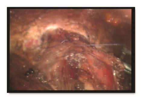 A H Intraoperative View Of Key Steps During Endoscopic Thyroidectomy Download Scientific