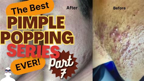 The Best Pimple Popping Series 7 Youtube