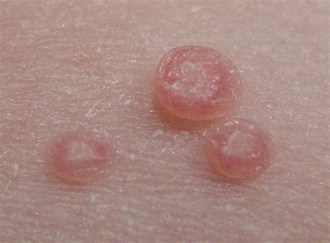 What Are Warts What Are The Various Treatments For Warts