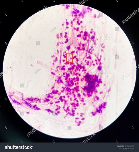 Gram Negative Diplococci Gonorrhea