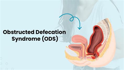 Defecation Disorder