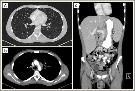 Criptococosis Diseminada En Un Paciente Inmunocompetente A Propósito